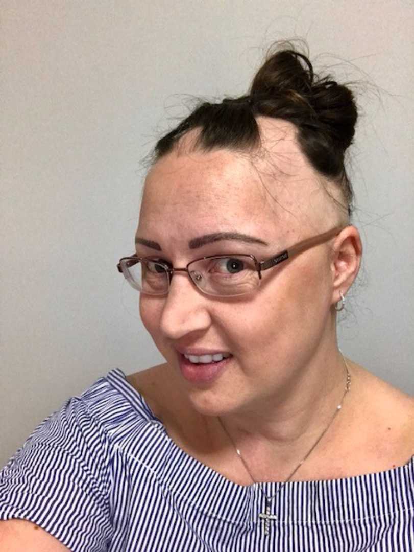 Australia Alopecia Areata Foundation | Madeleine Compion - The good ...